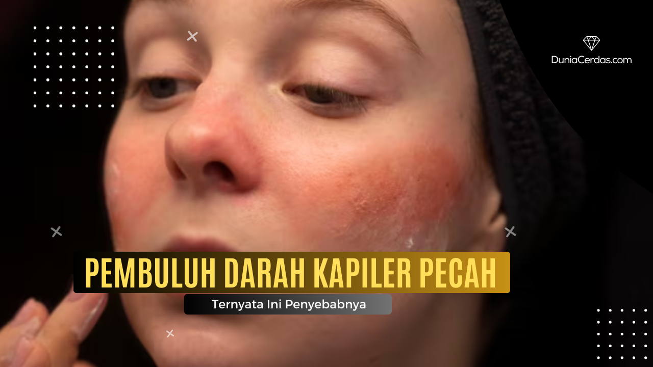 Pembuluh Darah Kapiler Pecah Ternyata Ini Penyebabnya - Dunia Cerdas