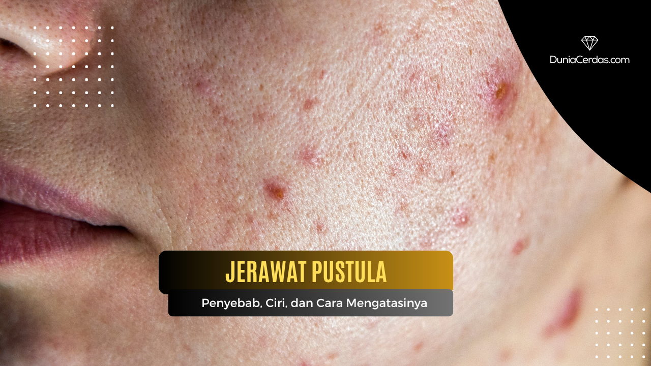 Jerawat Pustula Penyebab, Ciri-Ciri, dan Cara Mengatasinya - Dunia Cerdas